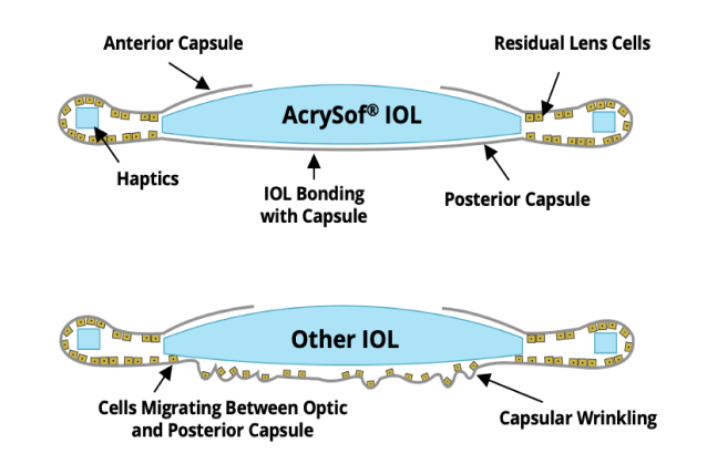 Acryof IQ Monofocal and AcrySof IQ Toric IOL | MyAlcon | India